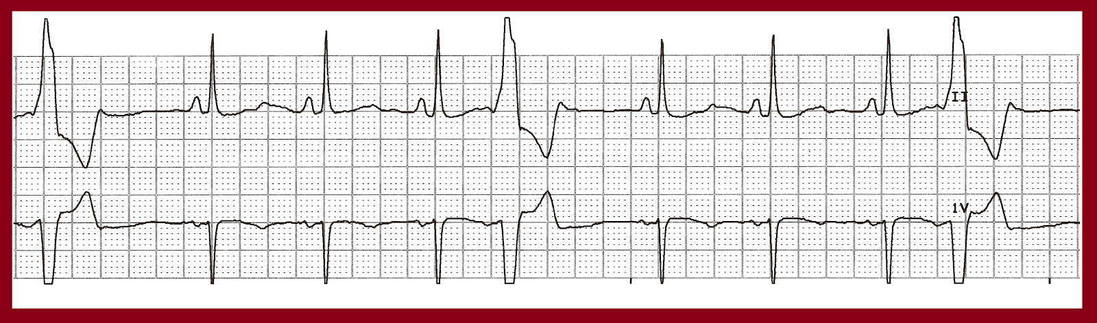 Basic EKG Rhythm Test 15
