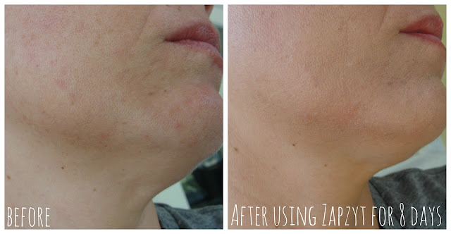 Zapzyt- a Real Solution For Real People With Acne!