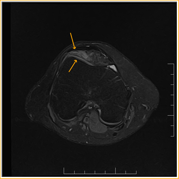 Superolateral Hoffa’s Fat Pad Edema: Patellofemoral Impingement - Sumer ...