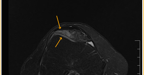 Superolateral Hoffa’s Fat Pad Edema: Patellofemoral Impingement - Sumer ...