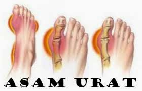 Asam Urat, Penyebab, Gejala serta Pantangannya