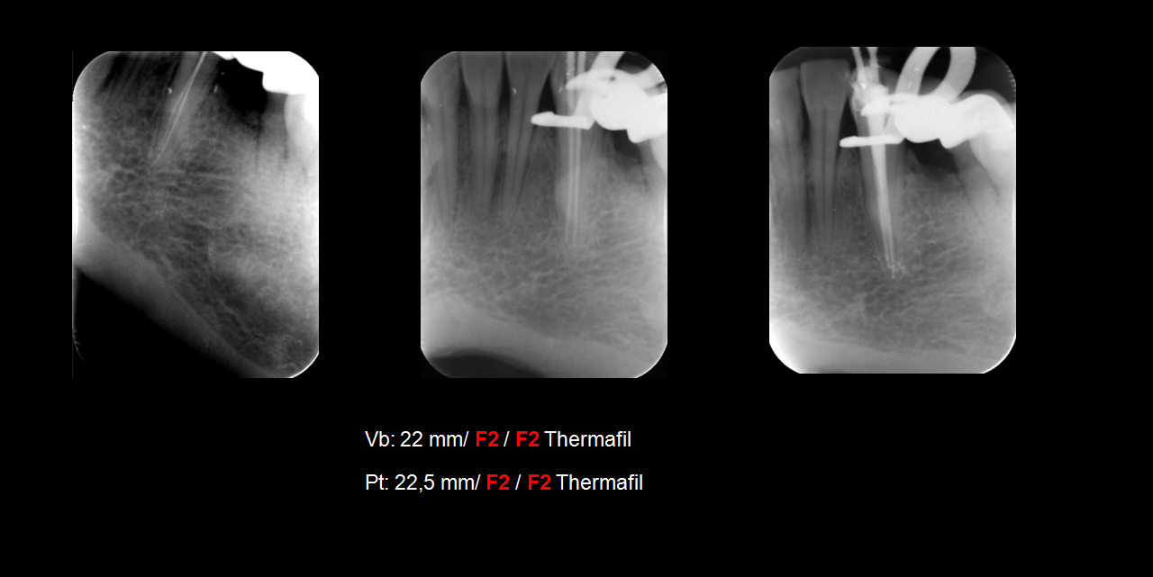 Máster en Odontología Restauradora y Endodoncia: Caso clínico. Canino ...