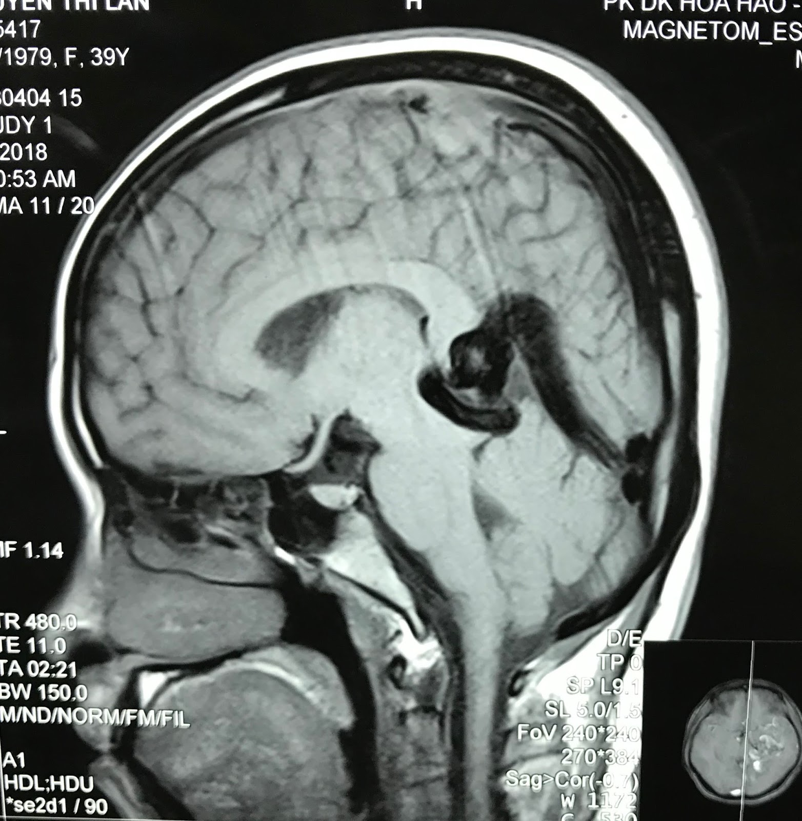 VIETNAMESE MEDIC ULTRASOUND: CASE 487: BRAIN AVM, Dr PHAN THANH HẢI ...