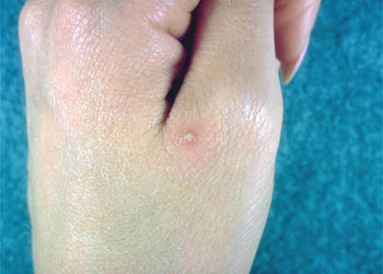 All In Nursing 4 Nursing Students..!!: Inflammation and Repair 1 ...