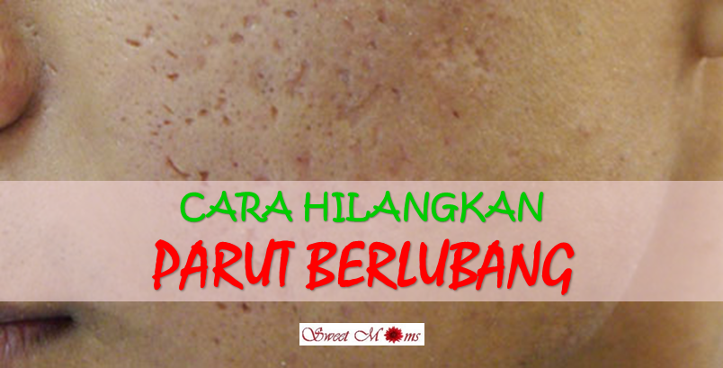 Cara Hilangkan Parut Jerawat Berlubang Dengan Mudah Dan Berkesan ...