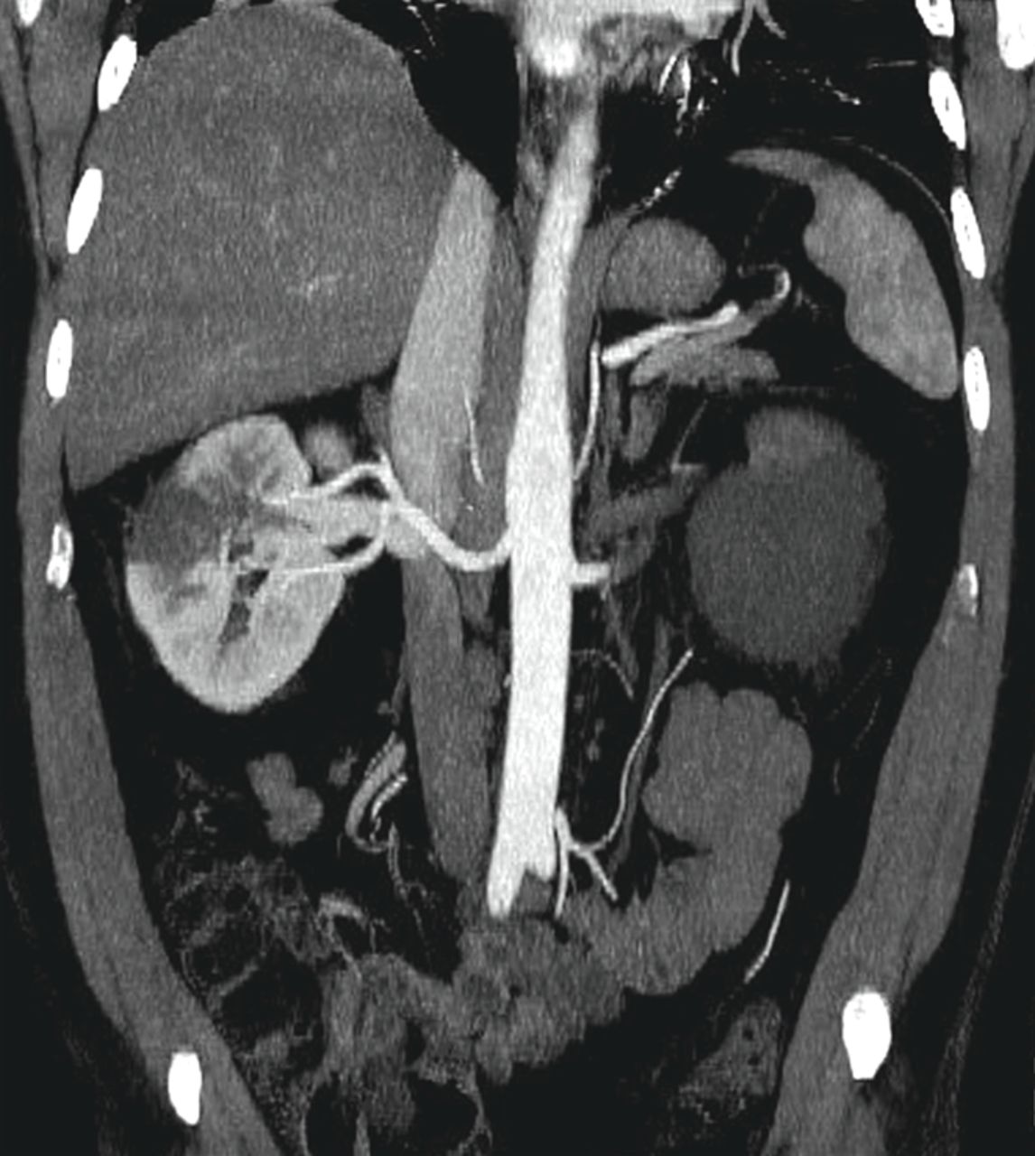 Clínica Médica - HUWC: Quiz #8: Qual a causa da dor em flanco esquerdo?