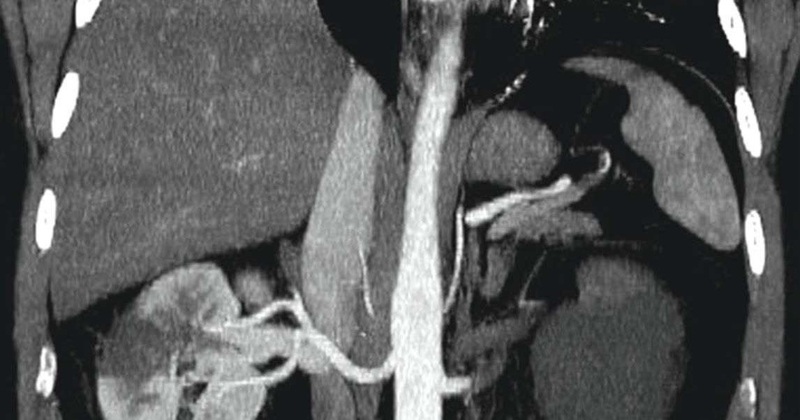 Clínica Médica - HUWC: Quiz #8: Qual a causa da dor em flanco esquerdo?