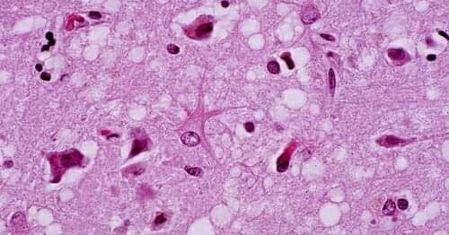 Pathology Of Prion Diseases