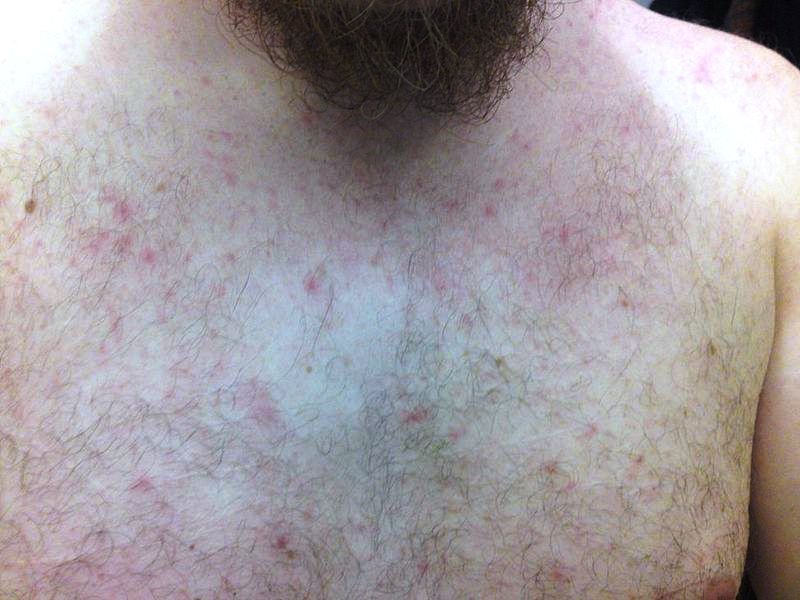 40 Jenis Penyakit Kulit Dan Gambarnya - Coremymages