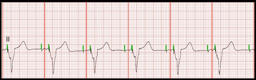 EKG Rhythm Strip Quiz 158