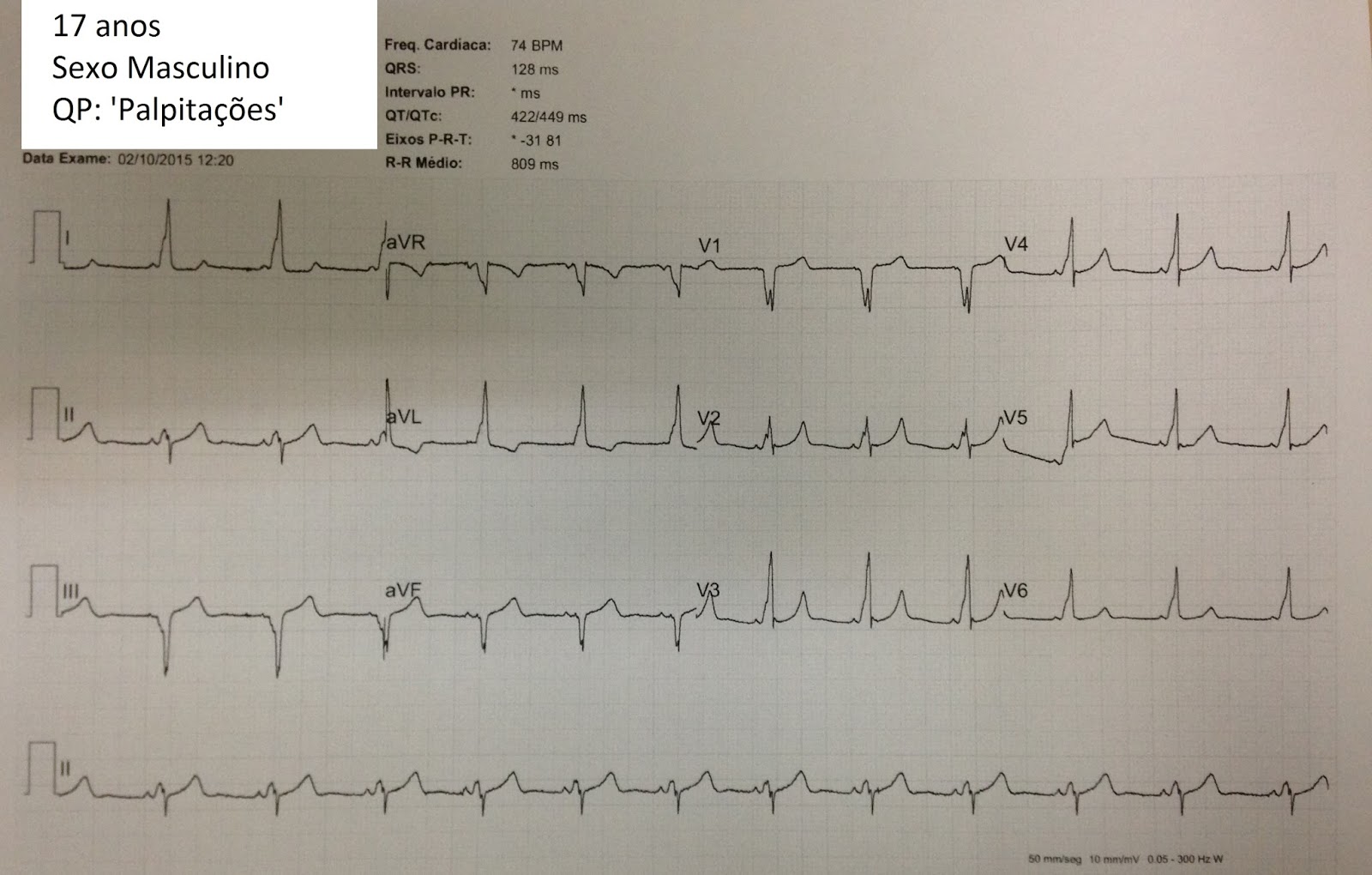 Temas em Cardiologia: Desafio de ECG 15 - Qual diagnóstico ...