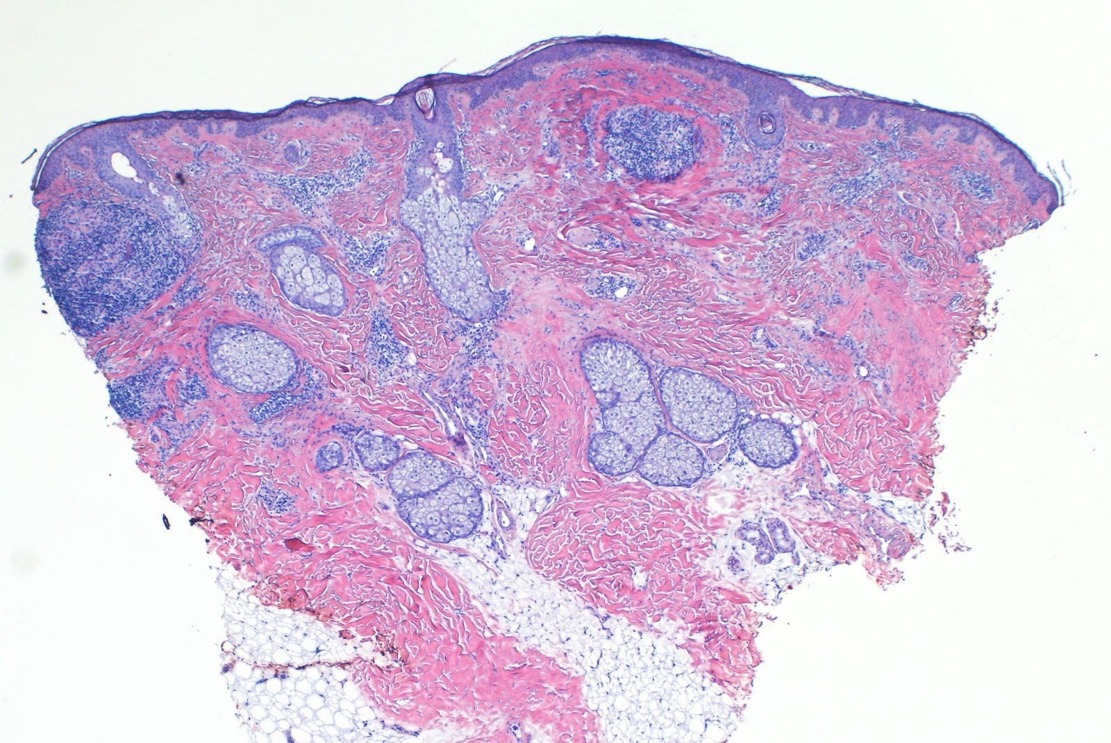 Granulomatous Rosacea Histology