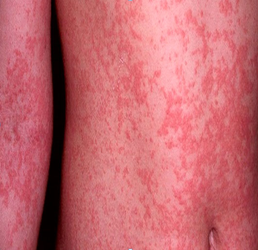 SOMOS A REDE ESTAMOS NA REDE: ESTÁ FORMADO O GT CONTRA O ZIKA-VÍRUS E A ...