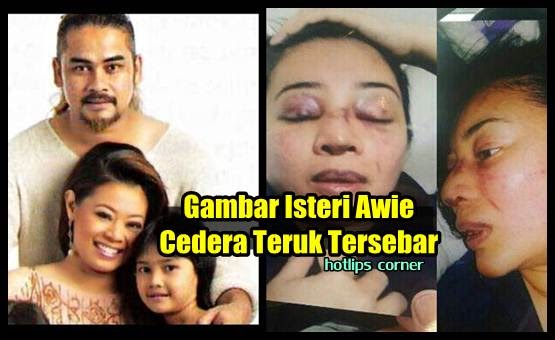 Gambar Isteri Awie Teruk Dipukul Tersebar - HOTLIPS CORNER