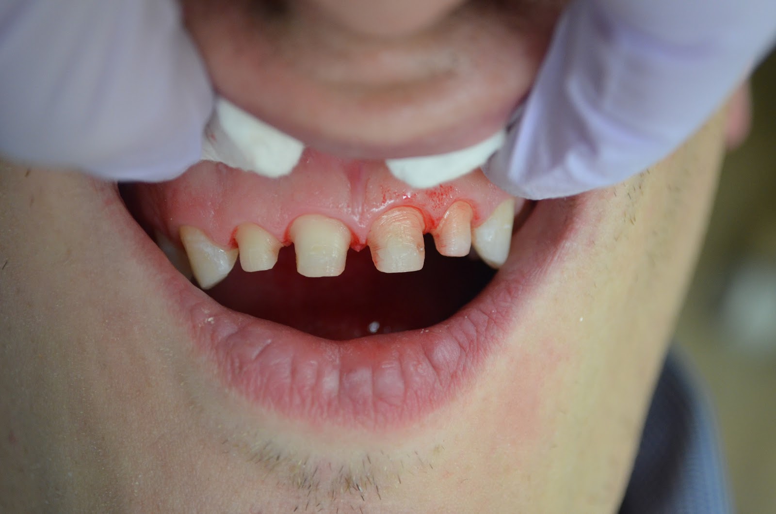 South Shore Smiles - Dr. Alice Cheng, DDS: Extensive Decay on Maxillary ...