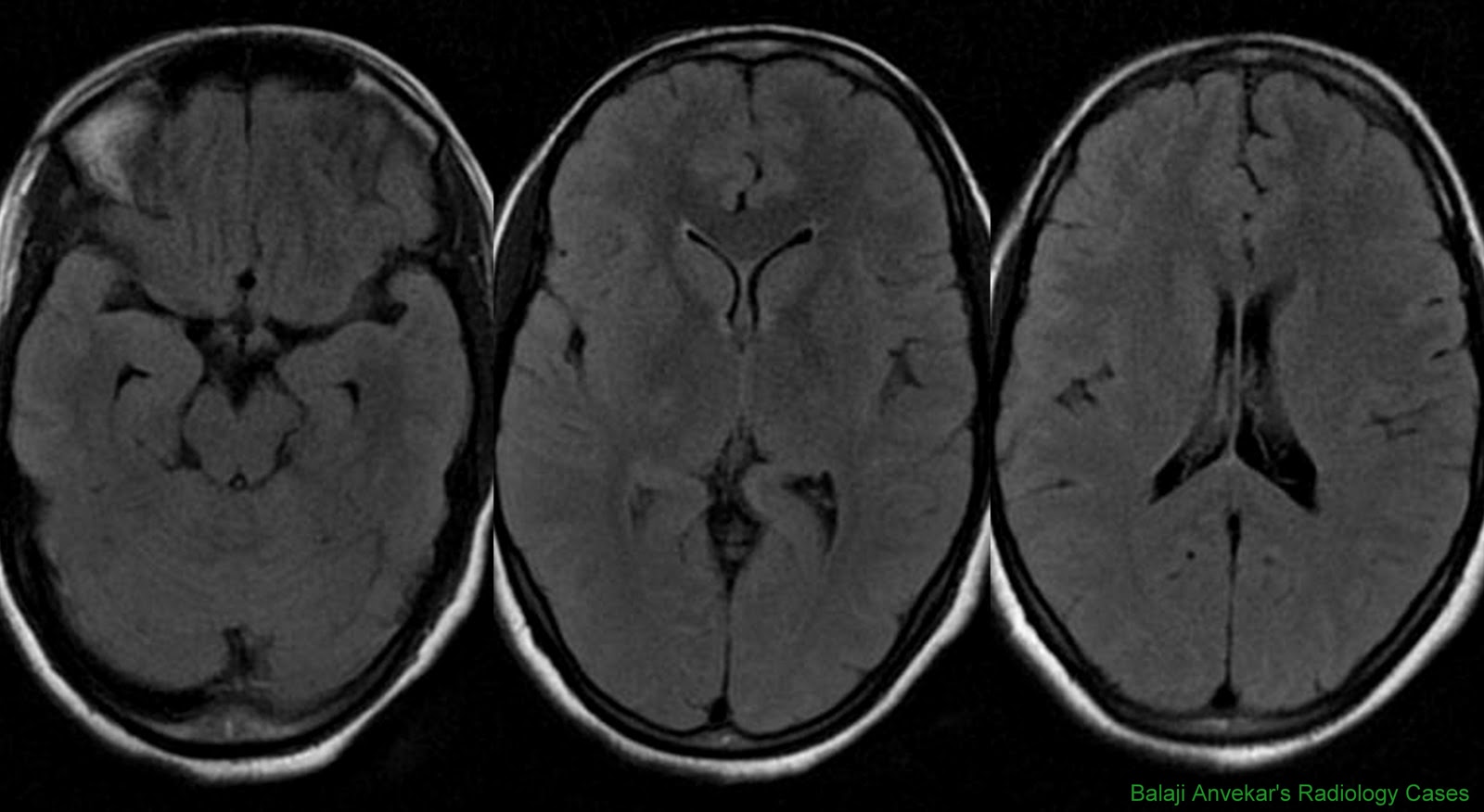 Dr Balaji Anvekar FRCR: Acute cerebellitis MRI