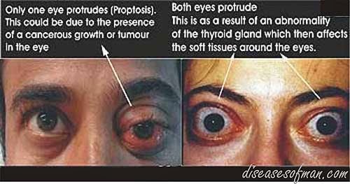 EXOPHTHALMOS (PROTRUSION OF THE EYES; ALSO KNOWN AS EXOPHTHALMIA OR ...