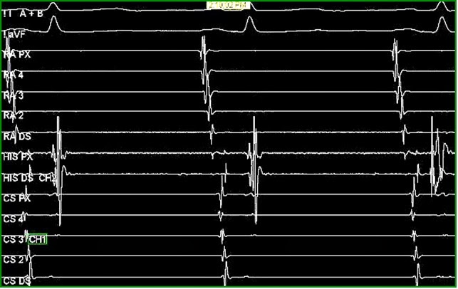 MUSC EP Education: How to Measure Basic Intervals