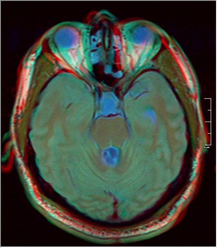Nevit's blog: Motion atrifacts, Color Brain MRI