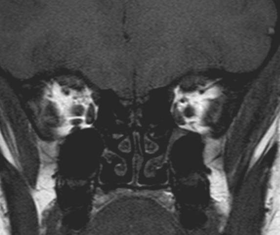 Inferior Rectus Anomalies-MRI - Sumer's Radiology Blog