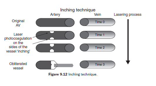 Selective laser | Twin-Twin Transfusion Syndrome (TTTS)