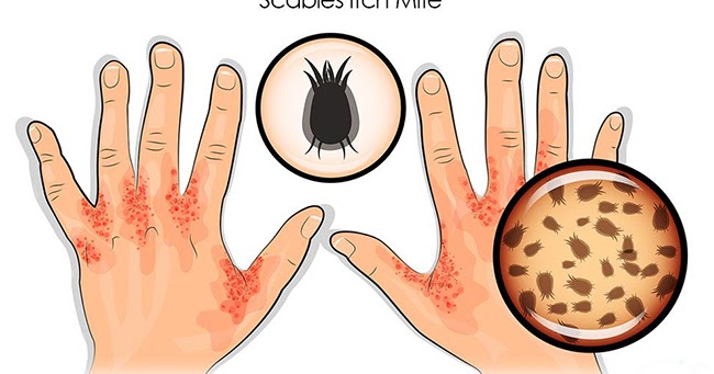 Ayurvedic Treatment for Scabies / Skin Mites - Symptoms, Causes ...