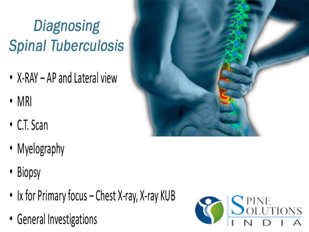 Spine Solutions India by Dr Sudeep Jain: Diagnosing Spinal Tuberculosis