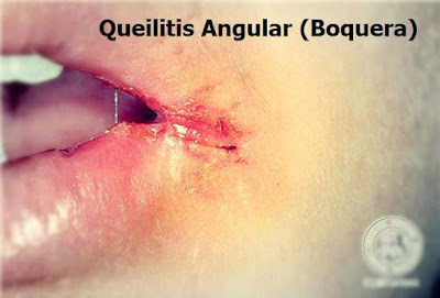 MEDICINA BUCAL: Queilitis Angular o "Boqueras" - Odontología Virtual