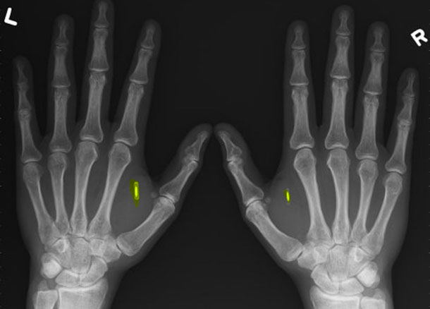 ¿Microchips subcutáneos para ir al trabajo? Experiencias con RFID (I)