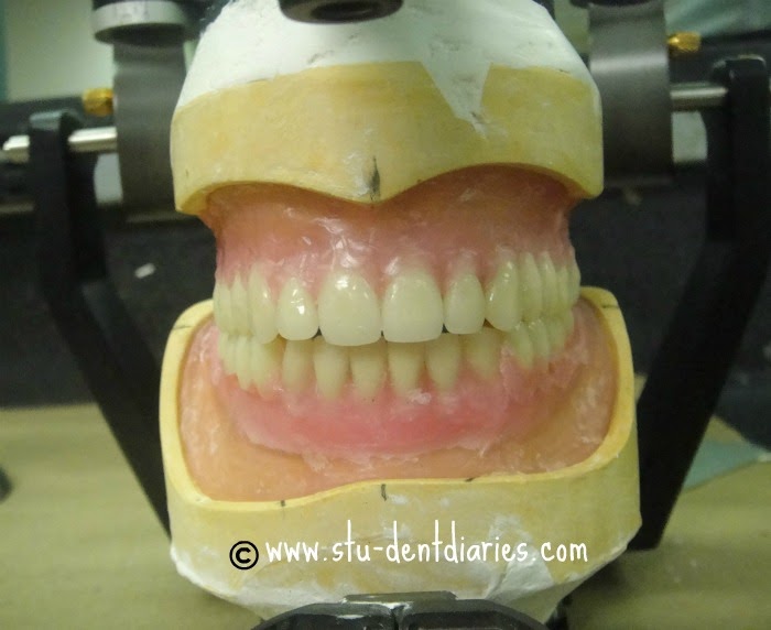Stu-DENT Diaries: Removable Prosthodontics: Complete Dentures