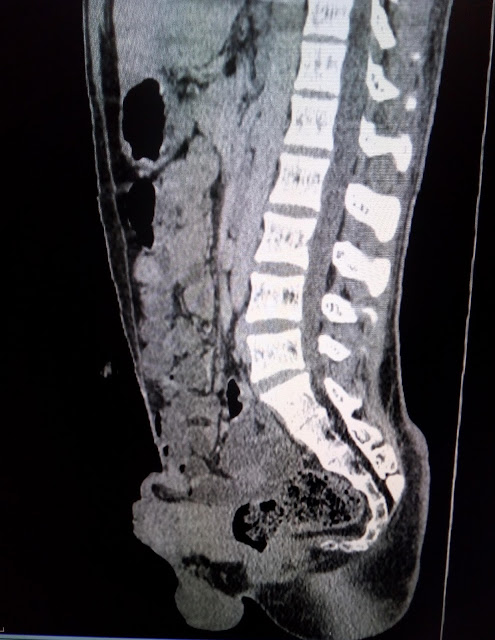 Bladder exstrophy – CT - Sumer's Radiology Blog