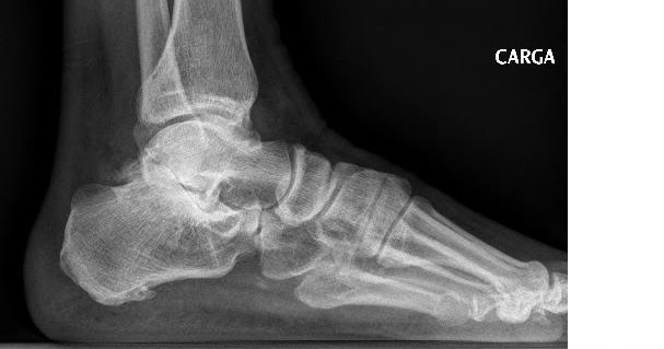 Fanáticos del pie: ARTROSIS SUBASTRAGALINA