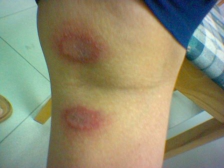 Cara merawat kulit yang terkena gigitan tomcat | Cara Merawat Kulit