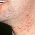 Skintherapy.. Ask the Esthetician: Staph Infection...Commonly Mistaken ...