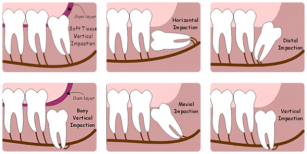 cherish every cherry: Pengalaman sakit gigi geraham bongsu
