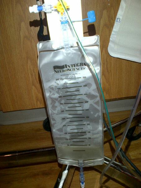 Rarely Defined: Revision/surgery #14: Lumbar drain surgery details ...