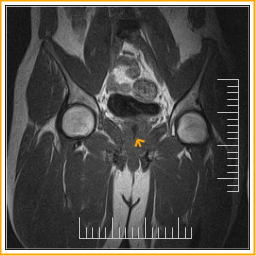 Prostatic utricle cyst-MRI - Sumer's Radiology Blog