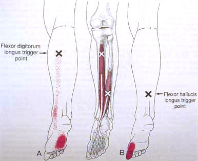 Paragon Physiotherapy: Flexor Hallucis Longus: FHL, Muscle of the Day