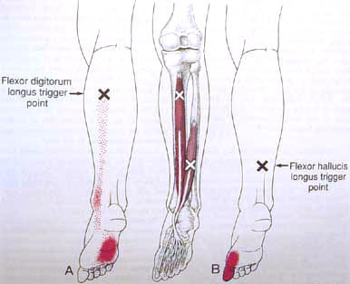 Paragon Physiotherapy: Flexor Hallucis Longus: FHL, Muscle of the Day