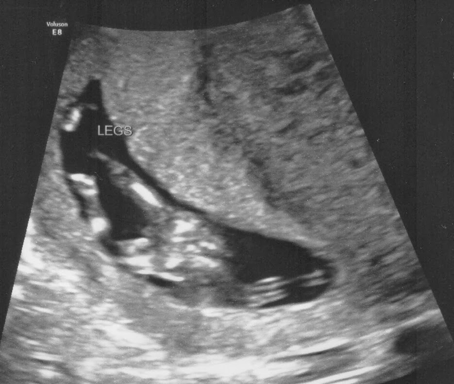 The Lion and the Lambes: Baby #3: 12 Week NT Scan