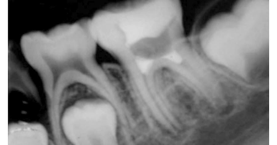 PDF: Apexogénesis de un molar inferior permanente joven con MTA ...