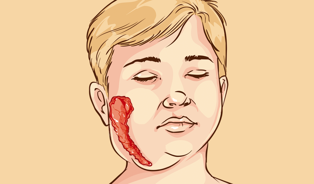 Oreionul la copii (Parotidita epidemica) | Dr. Francu Nicoleta