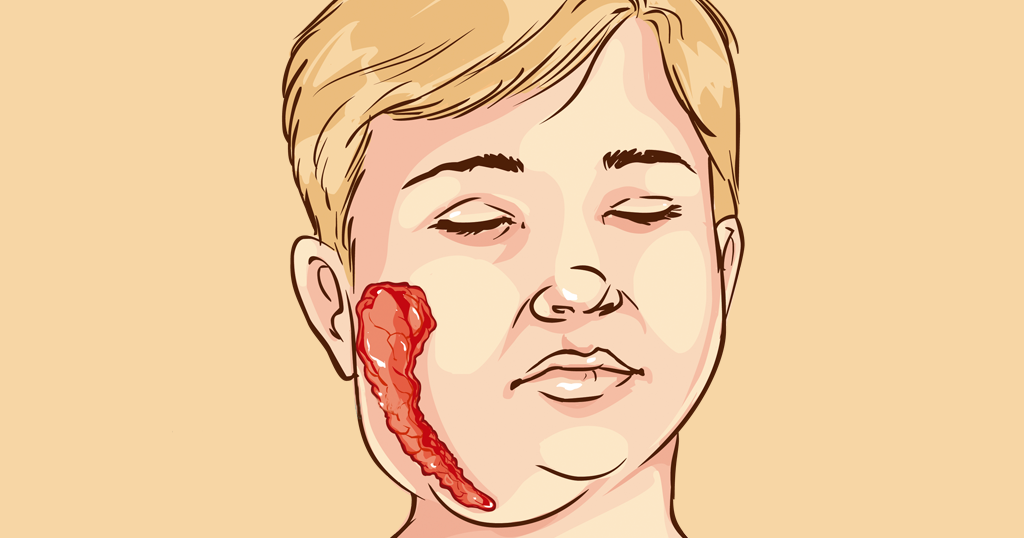 Oreionul la copii (Parotidita epidemica) | Dr. Francu Nicoleta