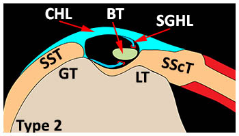 MRI Musculo-Skeletal Section: Long head of biceps dislocation grading.