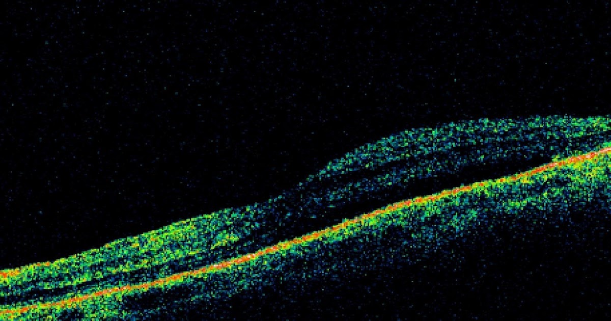 DEGENERACION MACULAR : OCT MACULA II