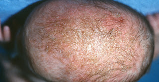 Moje kochane kłopoty: Ciemieniucha przy atopówce