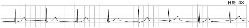 Belajar EKG PREMATURE JUNCTIONAL COMPLEX (PJC), JUNCTIONAL RHYTM ...