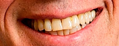 Gum-filled teeth, golfballs and telegraph cables