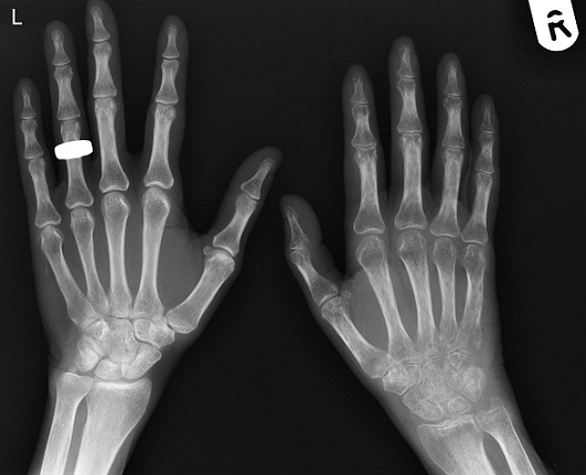 Síndrome de Sudeck ~ El Médico Contesta