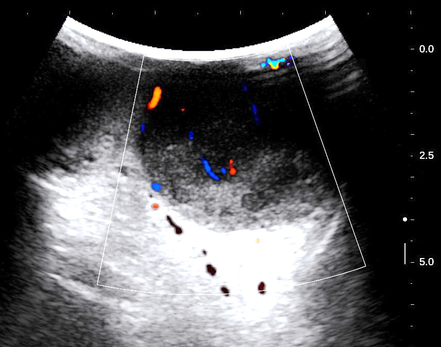 VIETNAMESE MEDIC ULTRASOUND: CASE 512: TESTICULAR TUMOR, Dr PHAN THANH ...